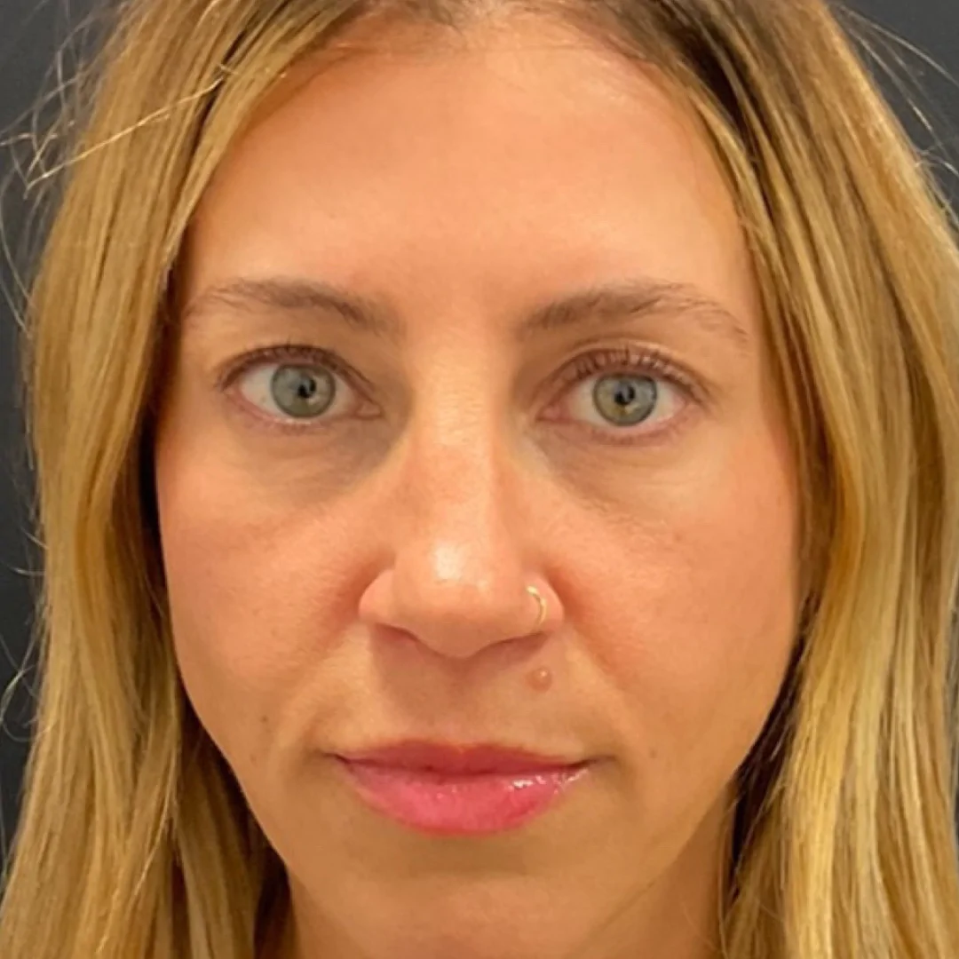 Injectables At LA ViE MD – Smooth, Lift, Refresh